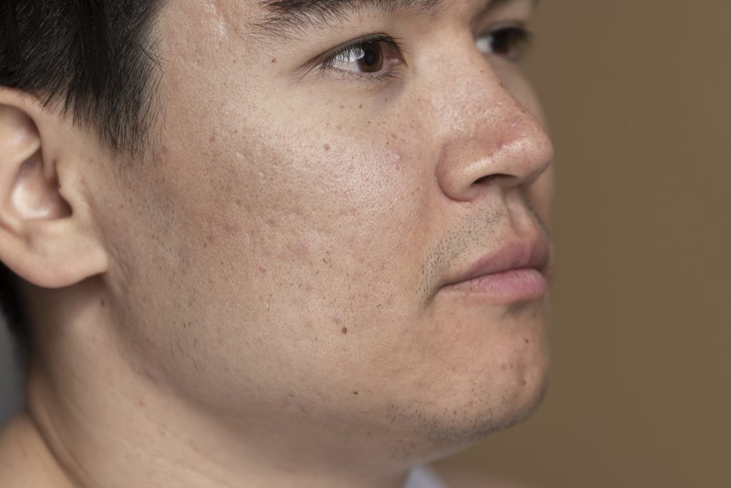 Open Pores: Causes, Treatments, Results & Prevention