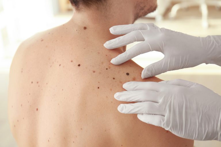 How To Remove Black Spots On Back And Neck - Tips & Treatment