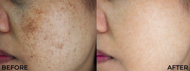 Best Pigmentation Treatment in Bangalore, Hyderabad, Chennai