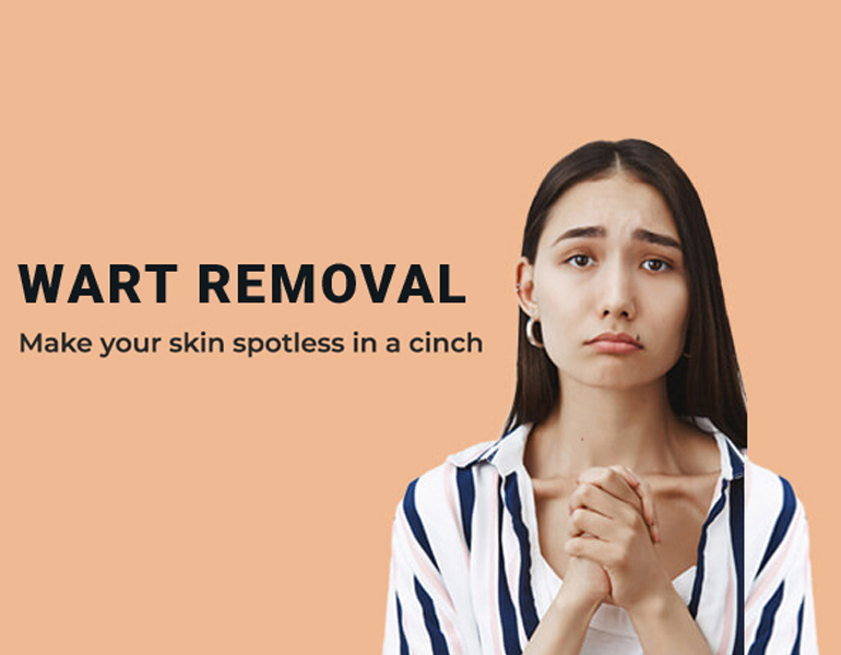 Best Wart Removal Treatment in Hyderabad, Chennai and Bangalore